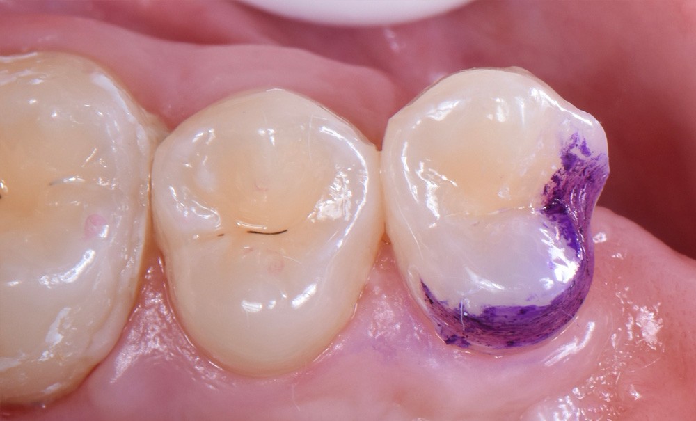 Le bridge collé canin en vitrocéramique : on adhère ! – L'Information ...