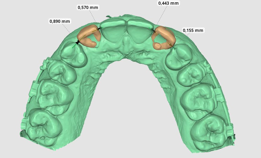 Les outils et flux de travail numériques élémentaires en dentisterie ...