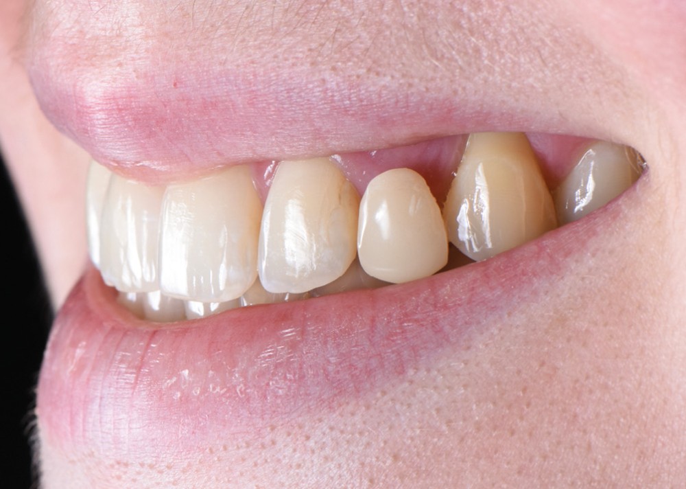 Le bridge collé canin en vitrocéramique : on adhère ! – L'Information ...