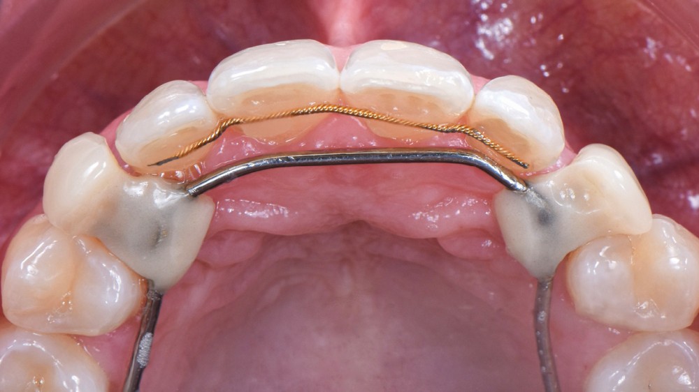 Le bridge collé canin en vitrocéramique : on adhère ! – L'Information ...