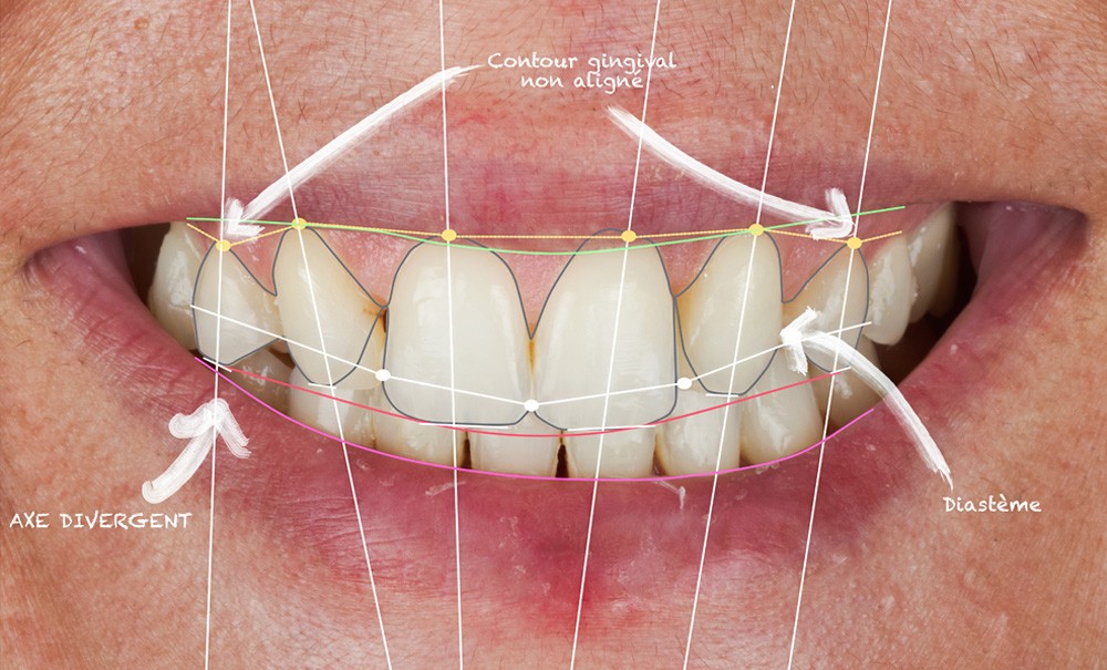 Approche esthétique de transformation des canines en incisive latérale ...