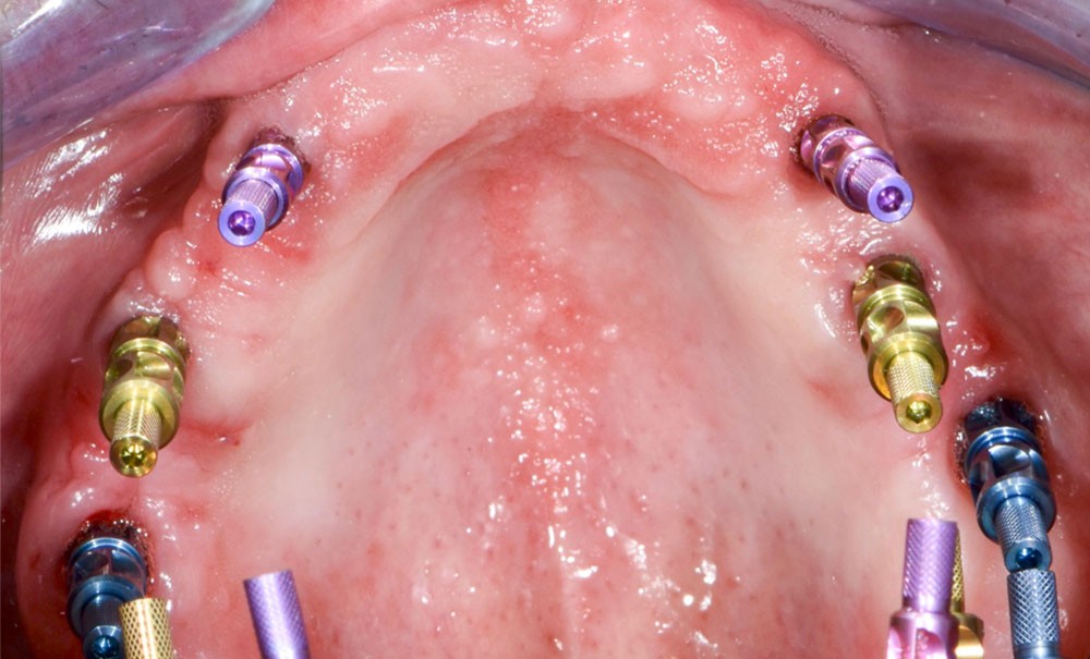 Restauration complète télescopique implanto-portée par le concept Conus ...