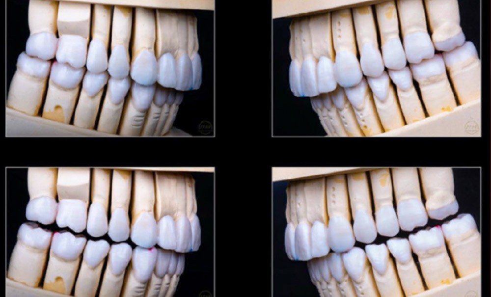 Courbe de Spee : pourquoi tant de « platitude » ? – L'Information Dentaire