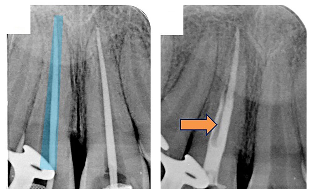 La technique monocône et les biocéramiques : le duo gagnant ? – L ...
