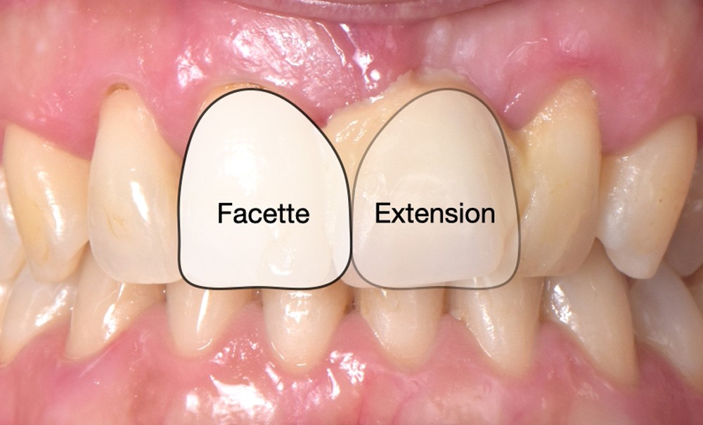 Facette avec extension : choix d’un matériau zircone de haute ténacité ...