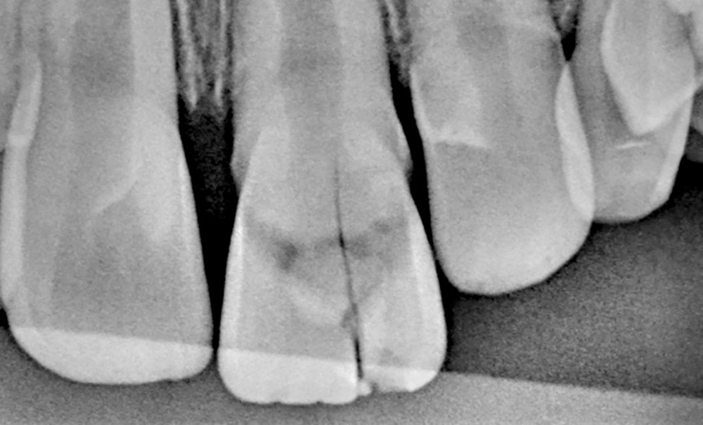 Prise en charge tardive d’une fracture corono-radiculaire complexe d ...