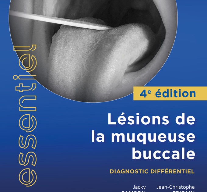 ESSENTIEL – Lésions de la muqueuse buccaleDiagnostic différentiel4e ...