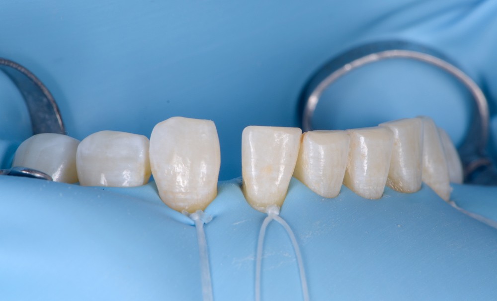 Diastème et dentisterie adhésive : quelle méthode pour quels matériaux ...