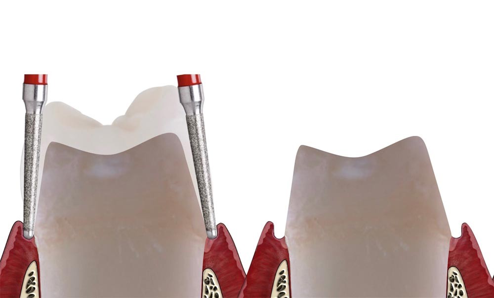 VERTIPREP : de quoi parle-t-on ? – L'Information Dentaire