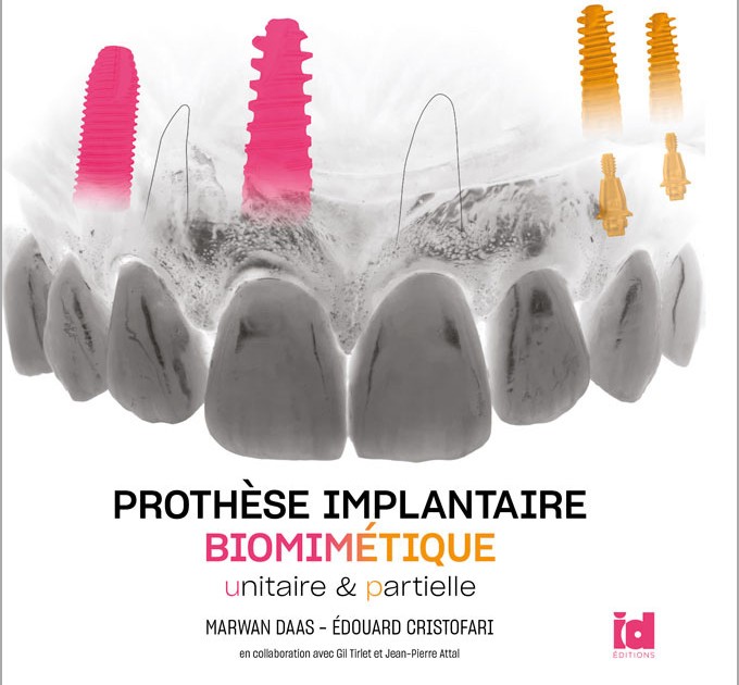 Prothèse implantaire biomimétique unitaire et partielle – L'Information ...
