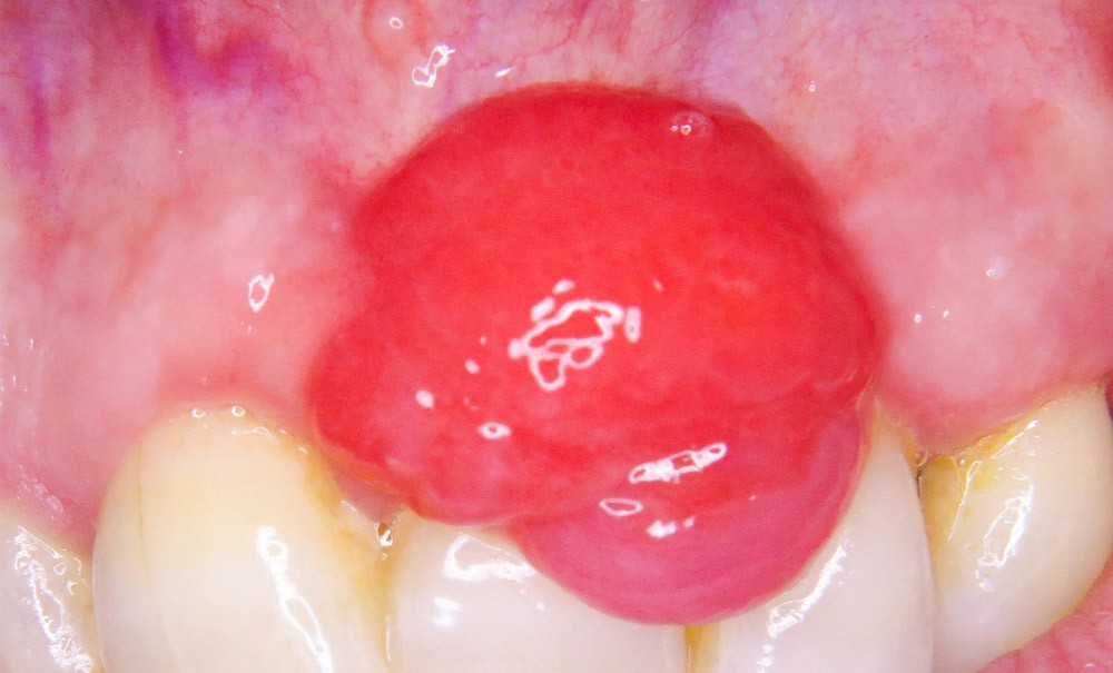 Les épulis – L'Information Dentaire